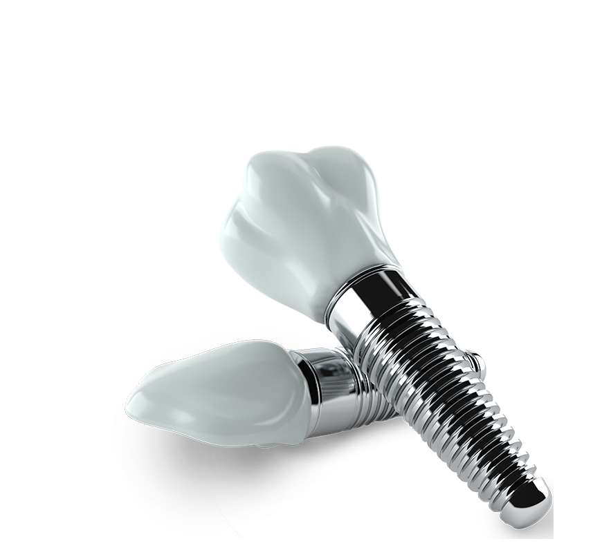 Benefits of Titanium Dental Implants - Bosetitanium